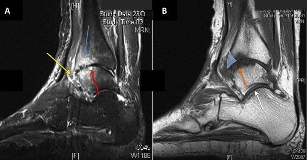 Ankle Arthritis | Arthritis Around The Ankle Joint | LFAC