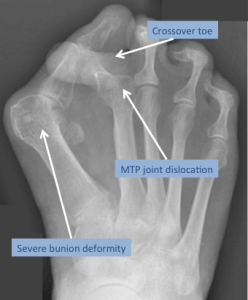 MTP Joint Dislocation | Mr Malik Orthopaedic Consultant