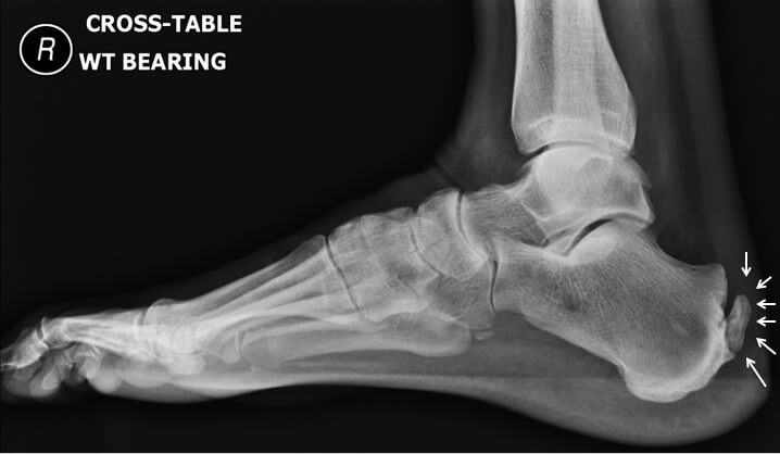 Achilles Tendon Pain | (Non) Insertional Achilles Tendinopathy