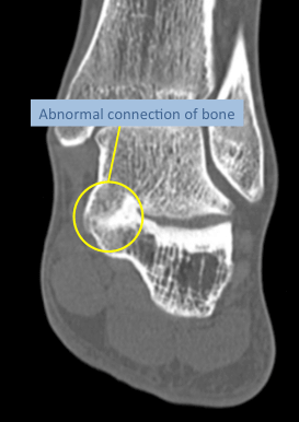Tarsal Coalition | Foot Conditions | The London Foot & Ankle Clinic