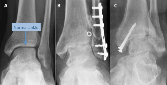 Ankle Fracture | Types & Treatment | The London Foot & Ankle Clinic