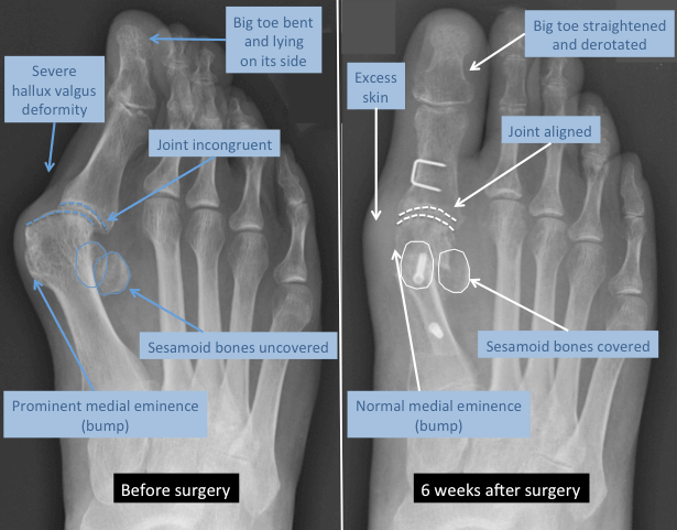 Hallux Valgus (Bunion) Conditions | The London Foot & Ankle Clinic