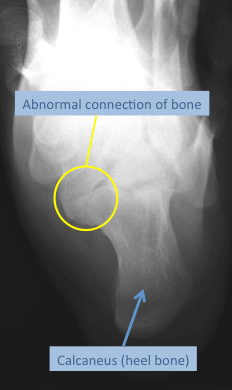 Tarsal Coalition | Foot Conditions | The London Foot & Ankle Clinic