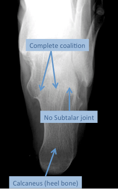 Tarsal Coalition | Foot Conditions | The London Foot & Ankle Clinic