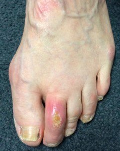 Claw Toe | Claw Toe Deformity | LFAC