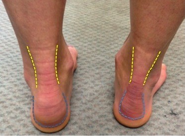 Achilles Tendon Pain | (Non) Insertional Achilles Tendinopathy