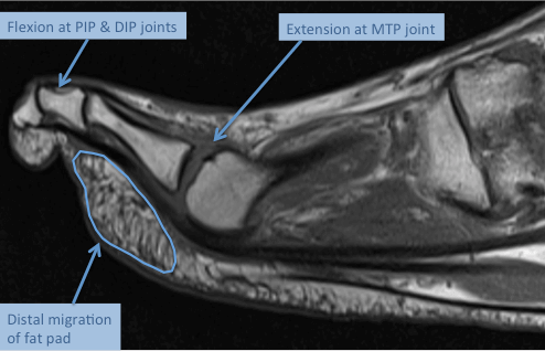 Claw Toe | Claw Toe Deformity | LFAC