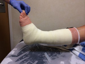 Patient Information | After Your Foot and Ankle Surgery