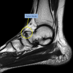 Tarsal Coalition | Foot Conditions | The London Foot & Ankle Clinic