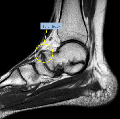 Tarsal Coalition | Foot Conditions | The London Foot & Ankle Clinic