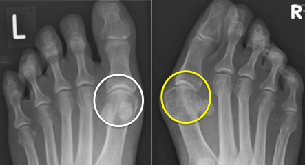 Big Toe Arthritis (Hallux Rigidus) | The London Foot & Ankle Clinic
