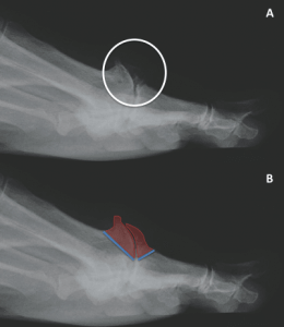 Big Toe Arthritis (Hallux Rigidus) | The London Foot & Ankle Clinic