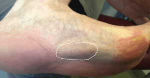 Plantar Fibroma and Fibromatosis | Mr Malik at LFAC
