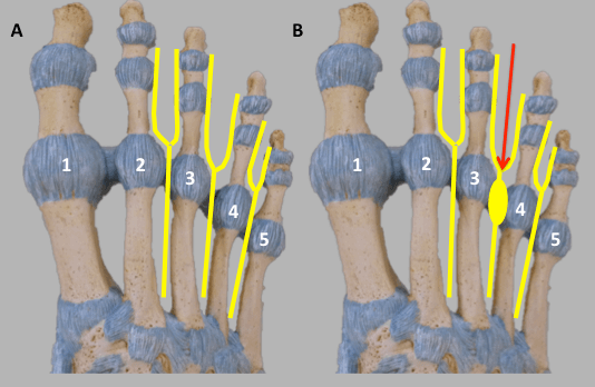 Morton's Neuroma | Mr Malik Orthopaedic Consultant | LFAC