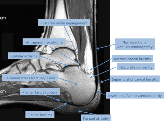 What Is Superficial Calcaneal Bursitis? | LFAC