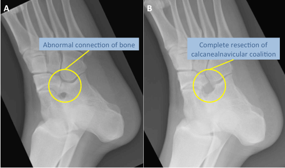 Tarsal Coalition | Foot Conditions | The London Foot & Ankle Clinic