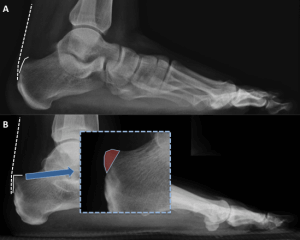 Retrocalcaneal Bursitis
