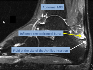Retrocalcaneal Bursitis