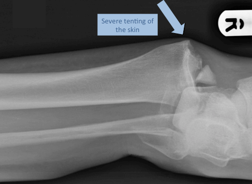 Ankle Fracture | Types & Treatment | The London Foot & Ankle Clinic
