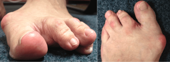 Hallux Valgus (Bunion) Conditions | The London Foot & Ankle Clinic