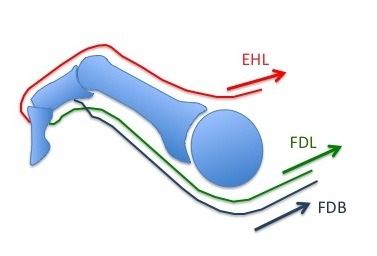 Claw Toe | Claw Toe Deformity | LFAC