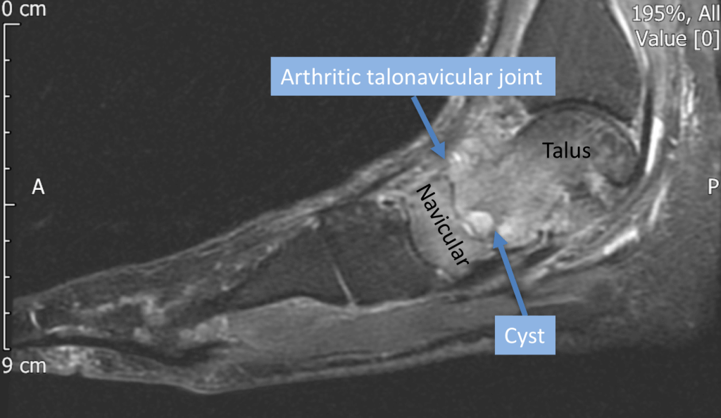 Talonavicular Arthitis | Arthritis Of The Talonavicular Joint