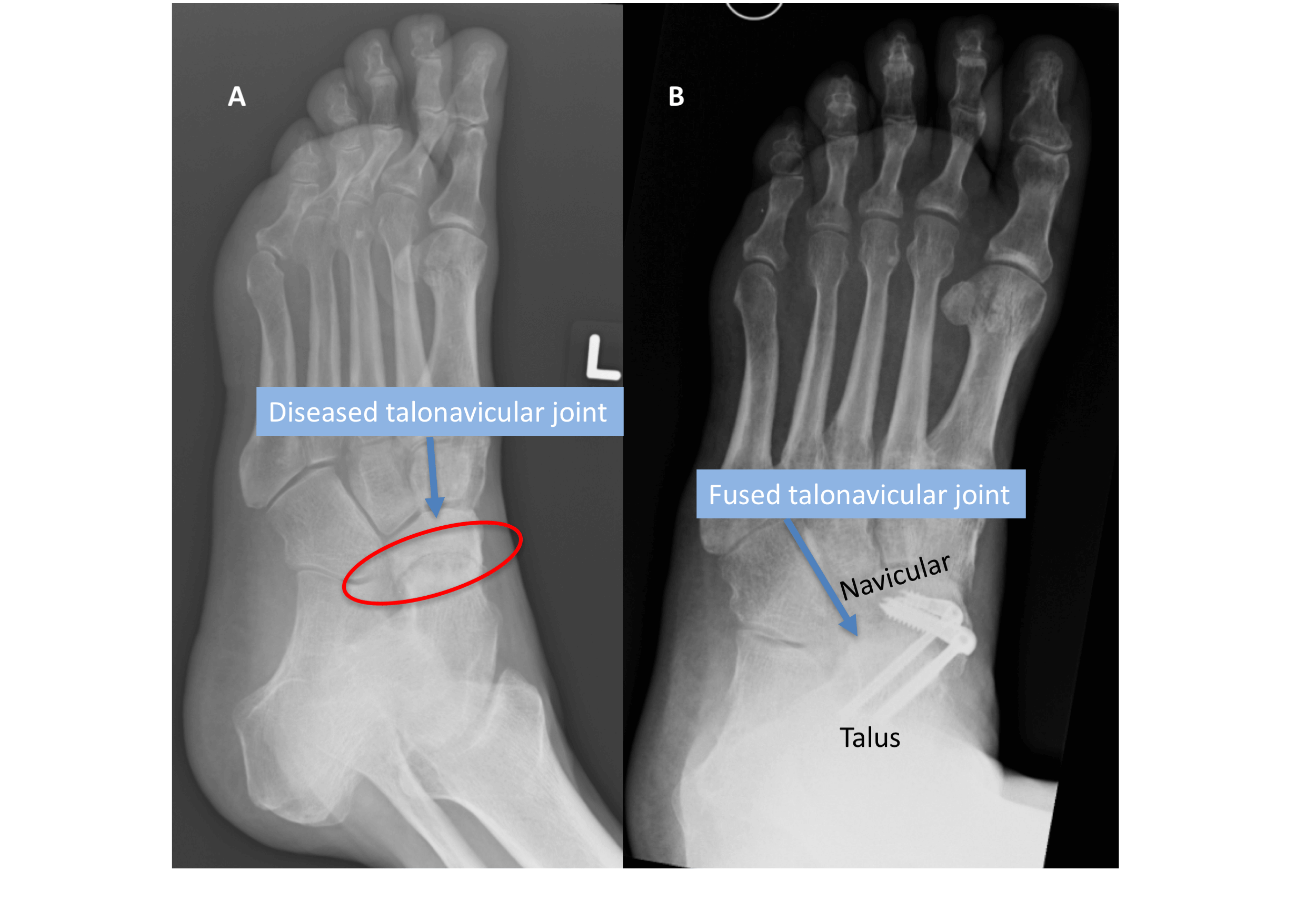 Talonavicular Arthitis | Arthritis Of The Talonavicular Joint