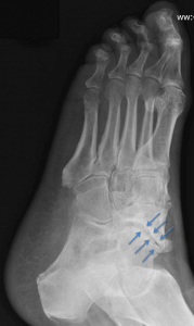 Talonavicular Arthitis | Arthritis Of The Talonavicular Joint